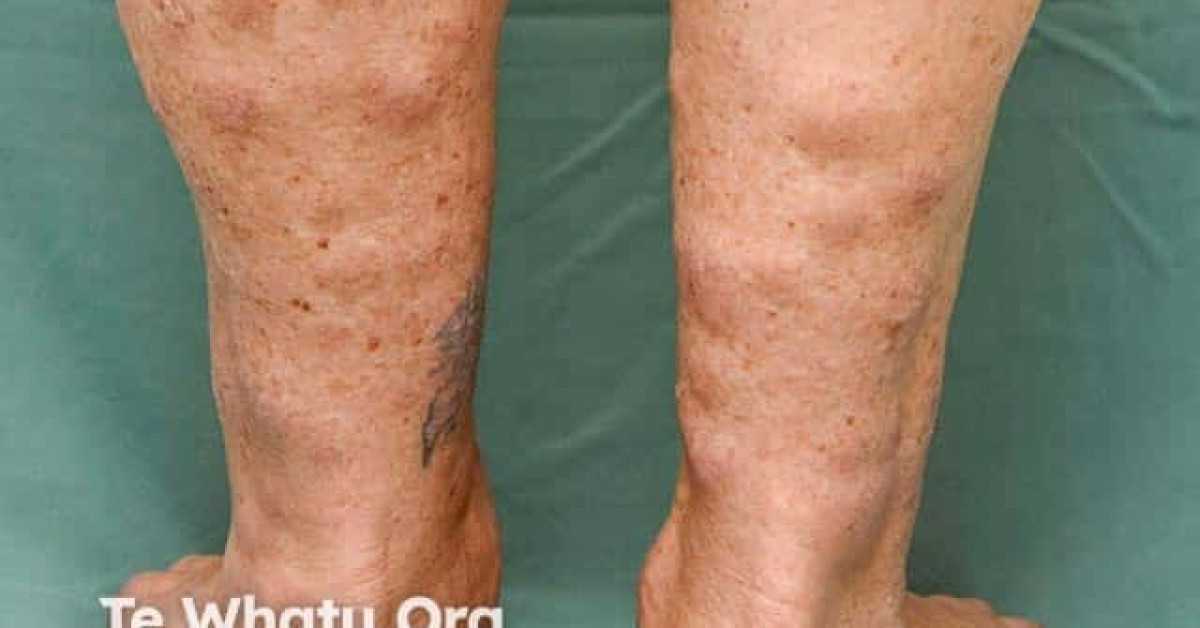 Patologia Do Mixedema Pre Tibial