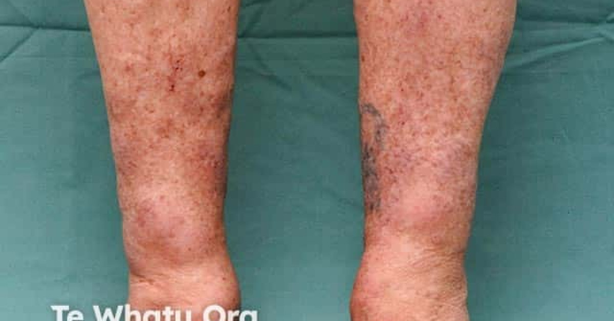 Pretibial myxoedema image