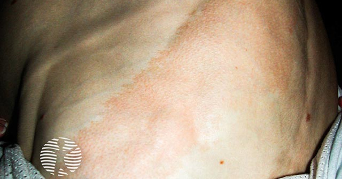 Proteus syndrome image