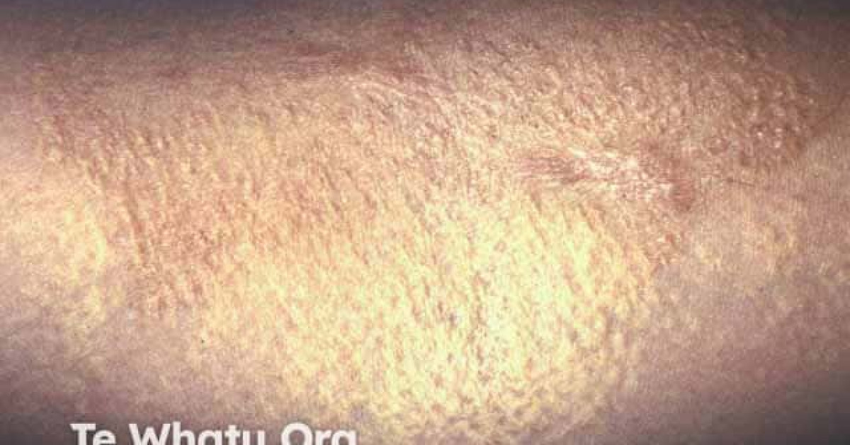 Pseudoxanthoma elasticum image