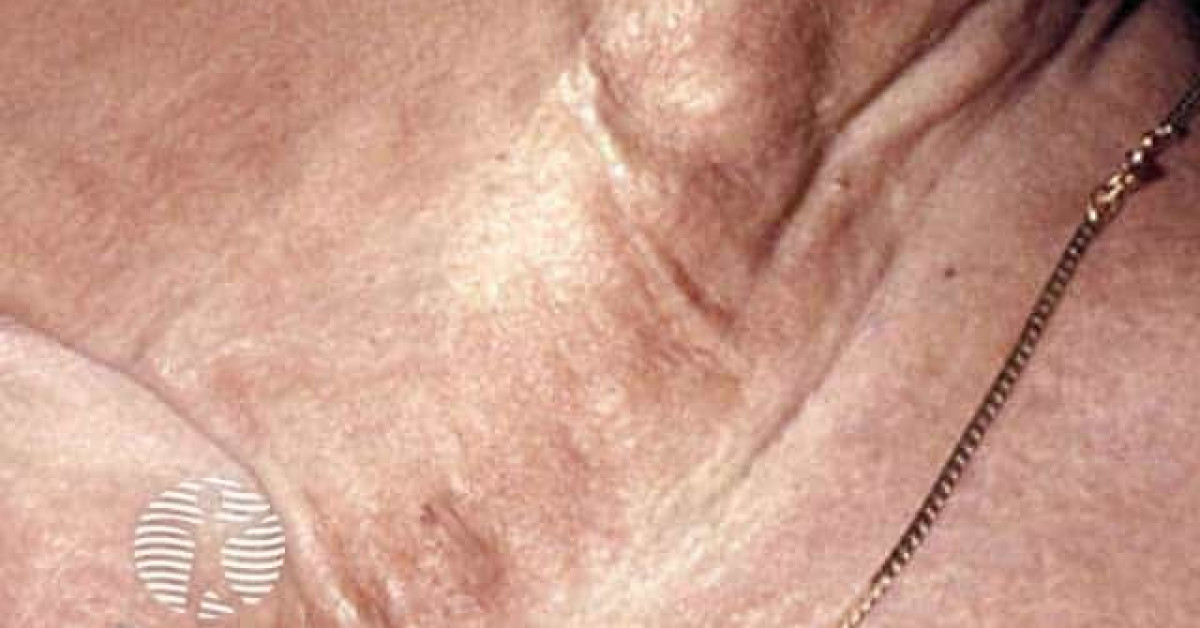 Pseudoxanthoma elasticum image