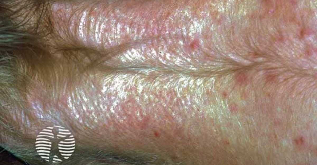 Pseudoxanthoma elasticum image