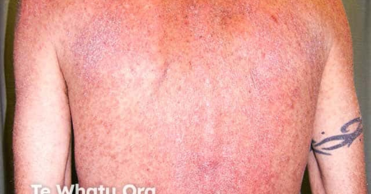 Psoriasis image