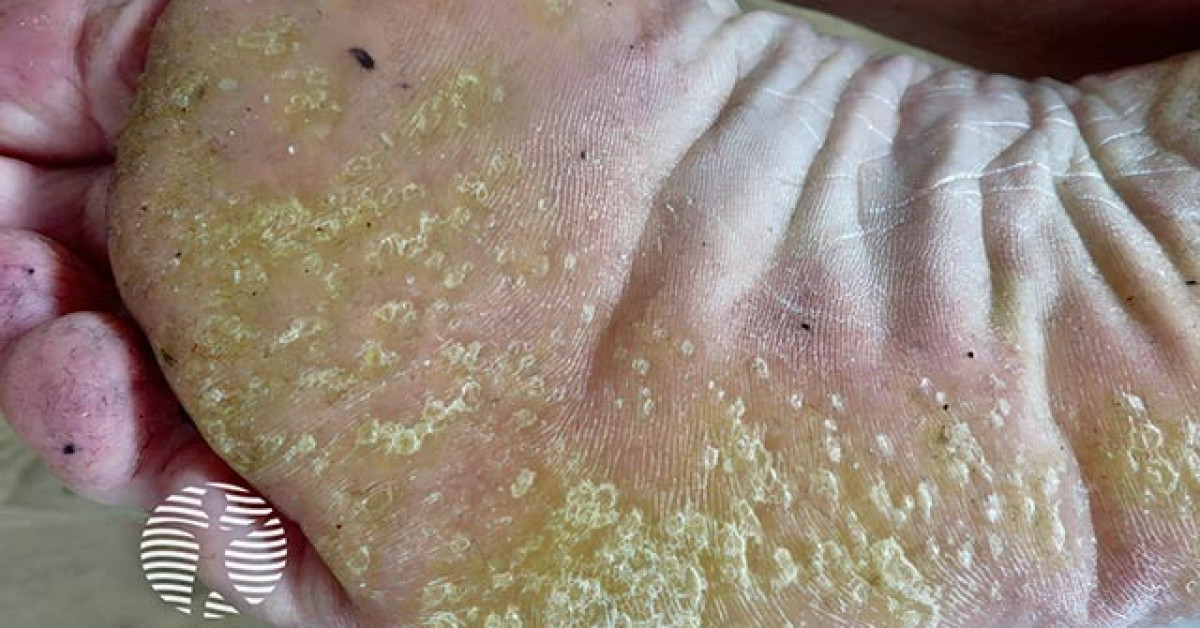 Punctate palmoplantar keratoderma image