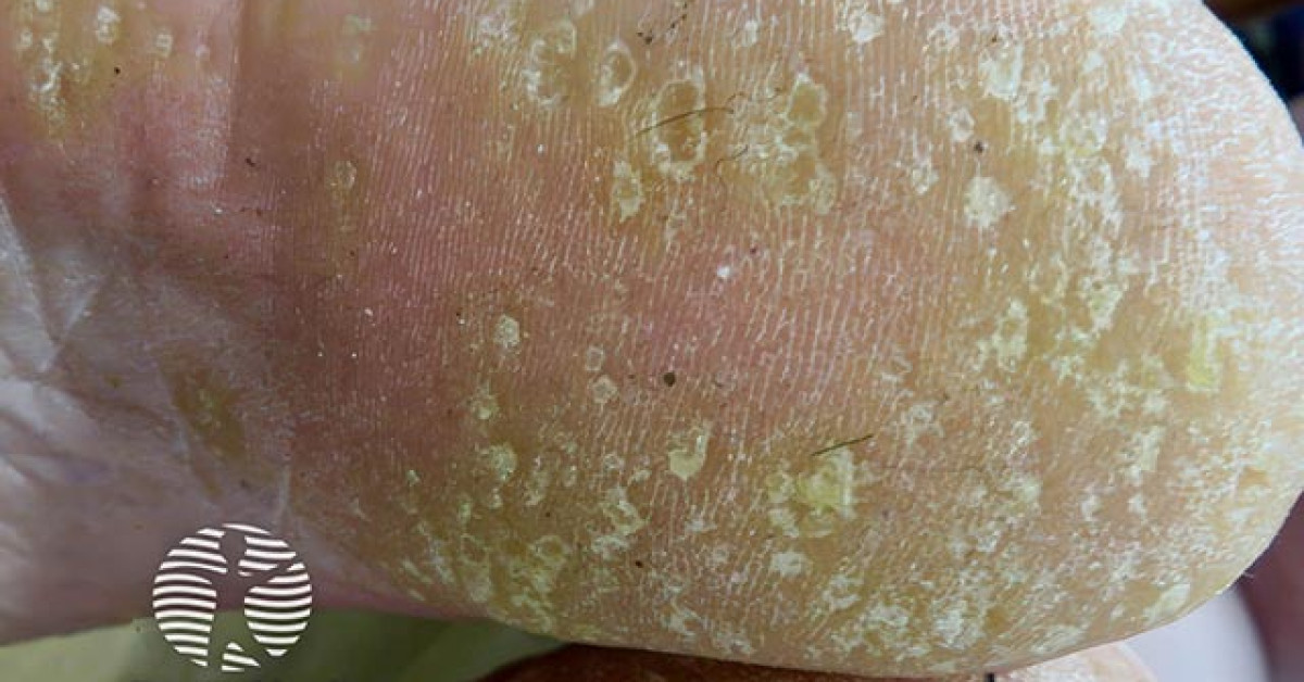 Punctate palmoplantar keratoderma image