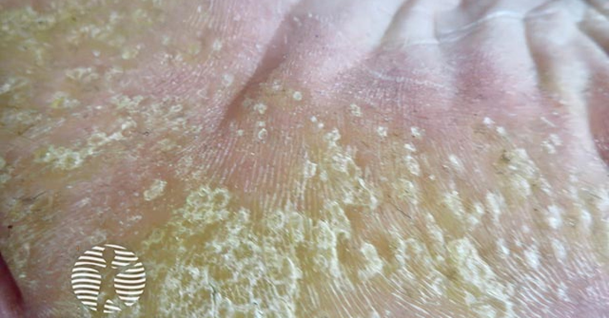Punctate palmoplantar keratoderma image