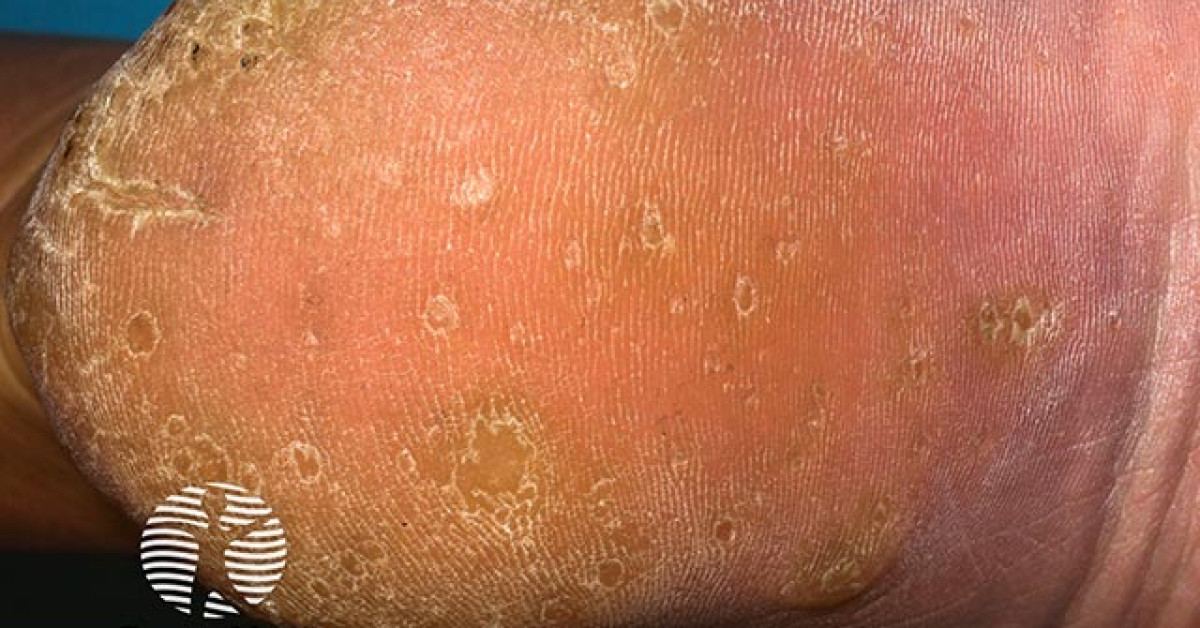Punctate palmoplantar keratoderma image