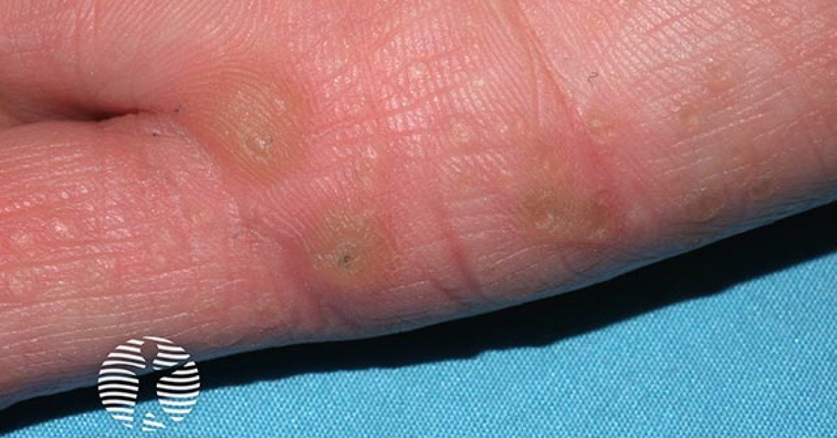 Punctate palmoplantar keratoderma image