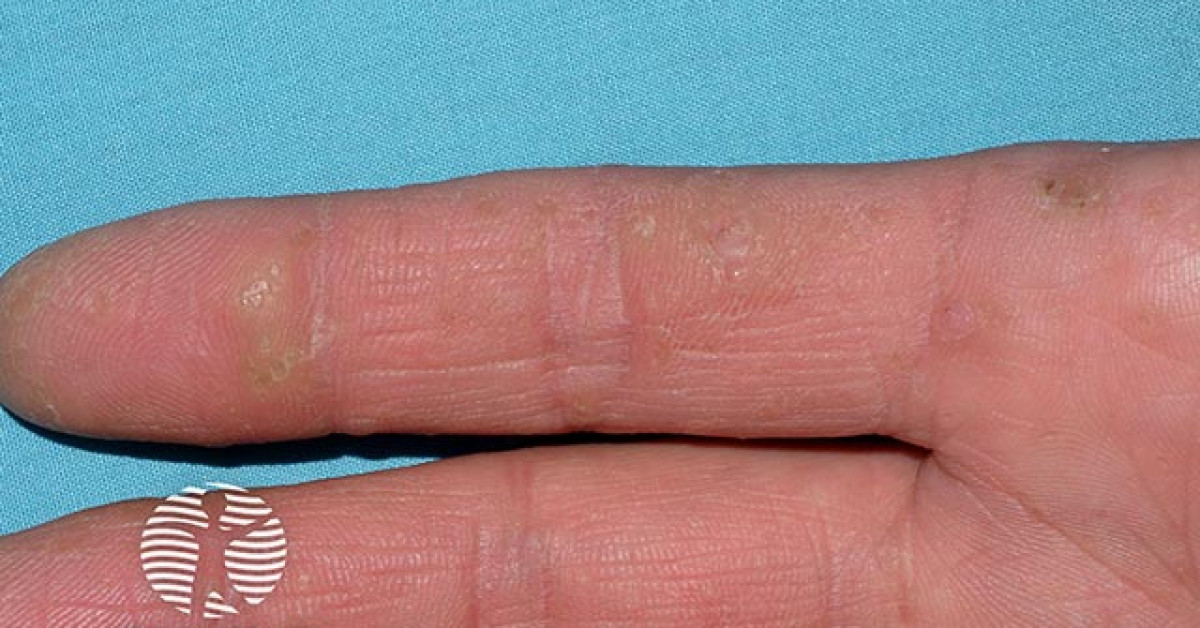 Punctate Palmoplantar Keratoderma Image