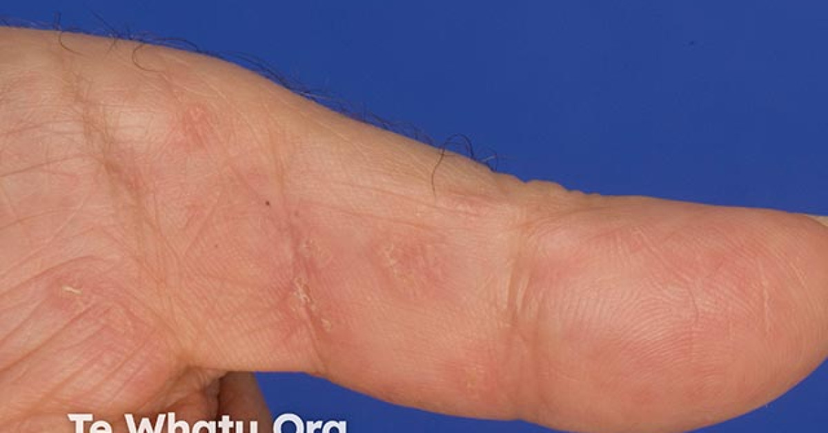 Punctate palmoplantar keratoderma image