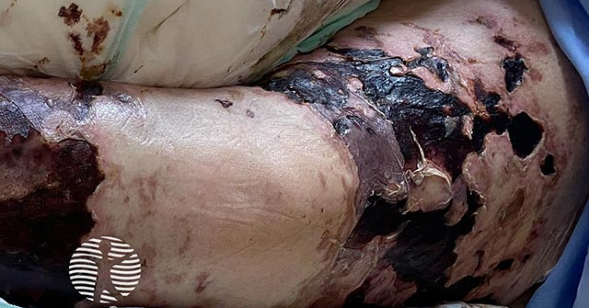 Purpura fulminans image