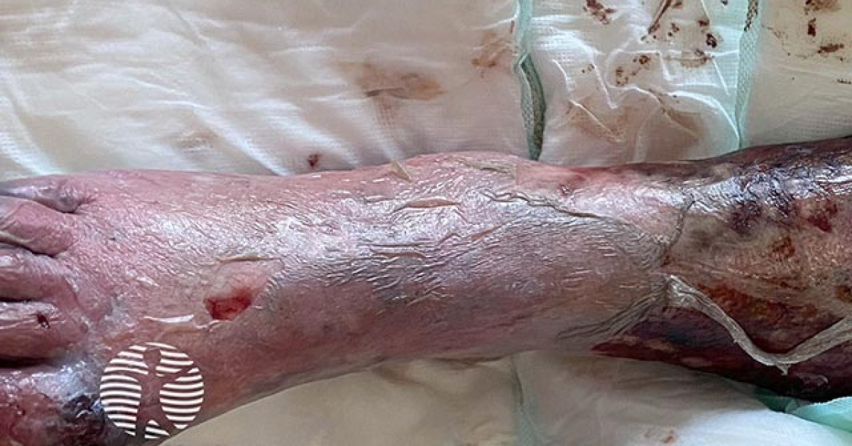 Purpura fulminans image