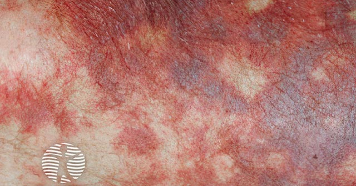 Purpura fulminans image