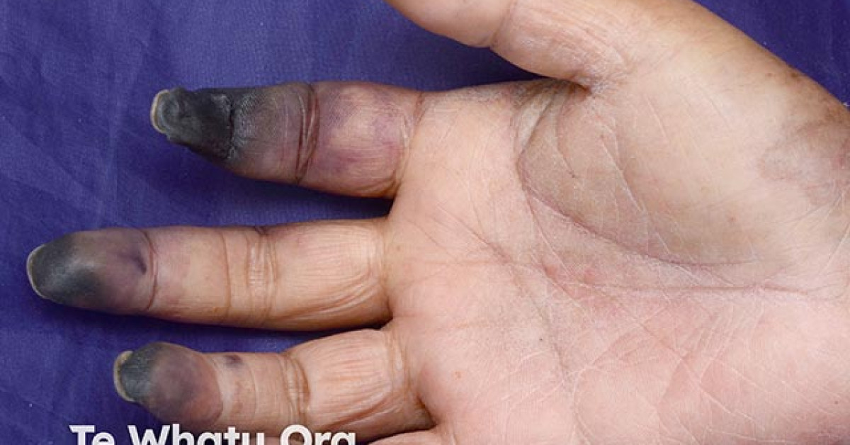Purpura fulminans image