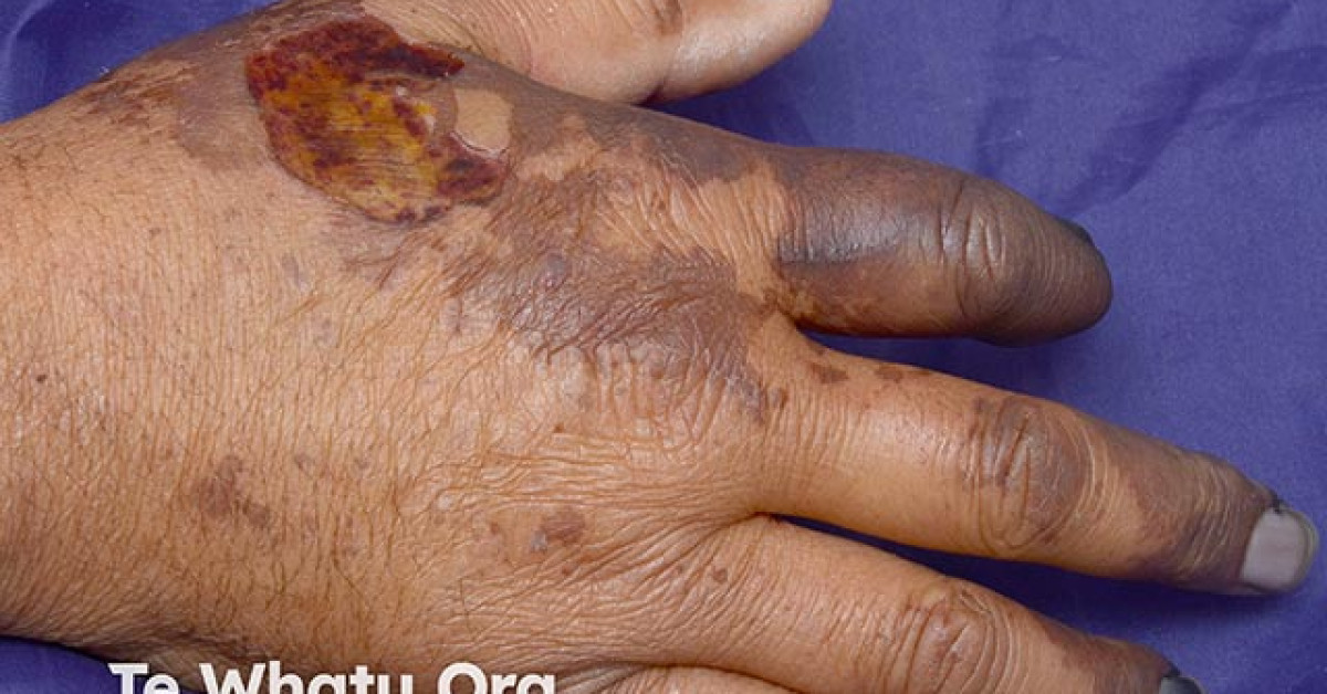 Purpura fulminans image