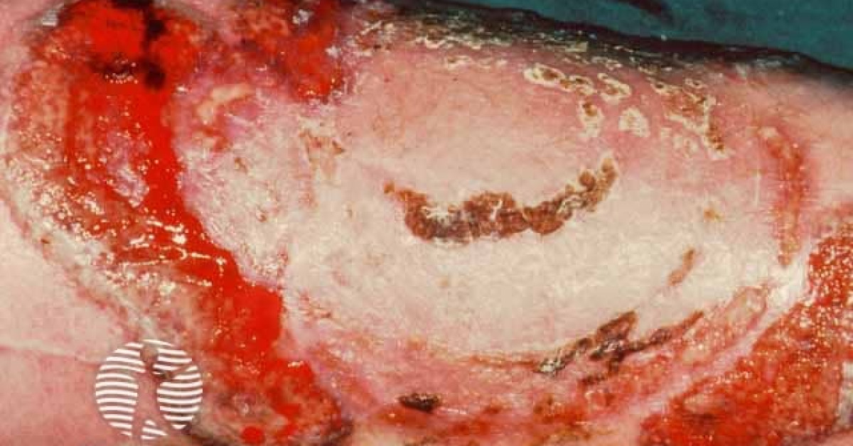 Pyoderma gangrenosum image