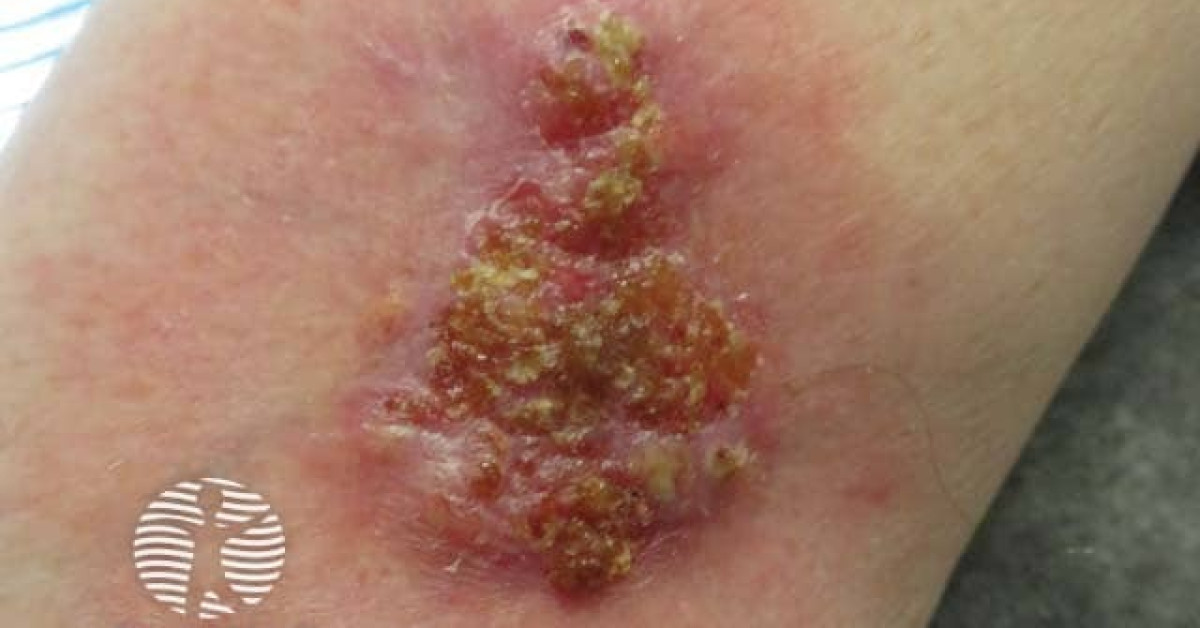 Pyoderma gangrenosum image