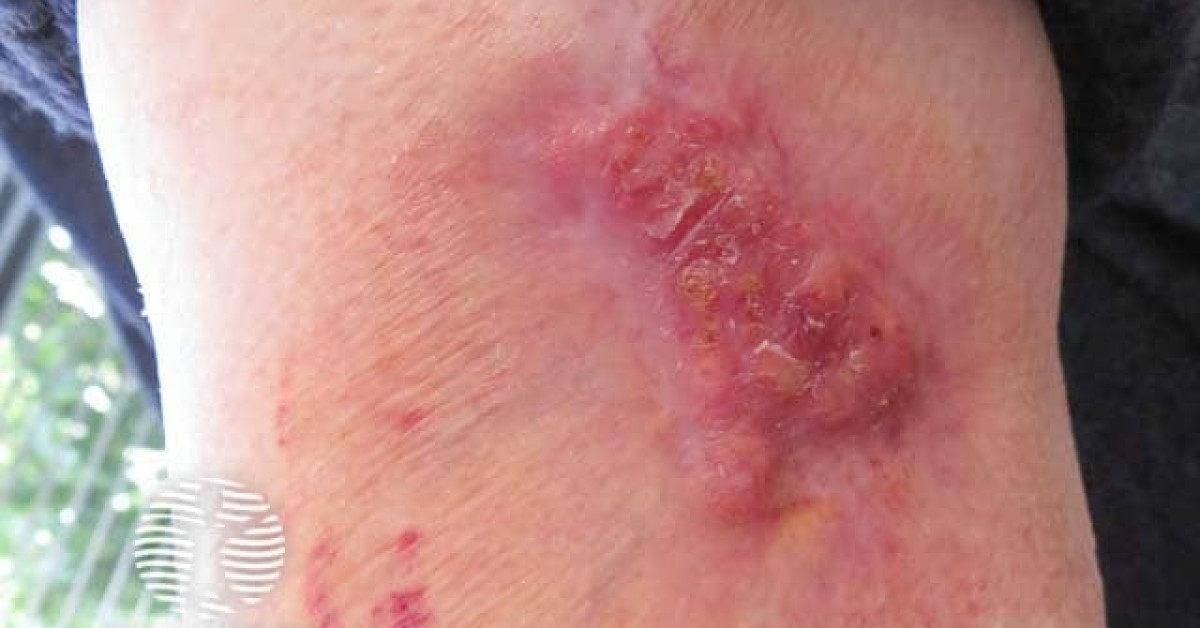 Pyoderma gangrenosum image