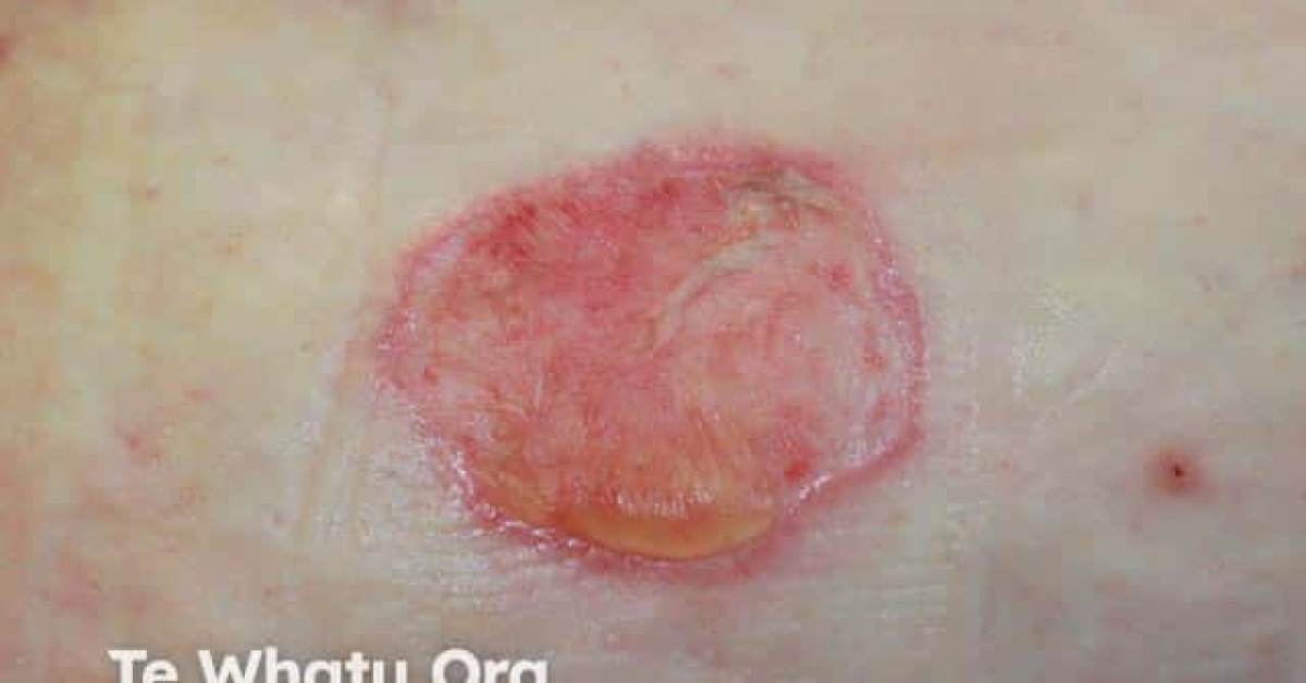 Pyoderma Gangrenosum Image