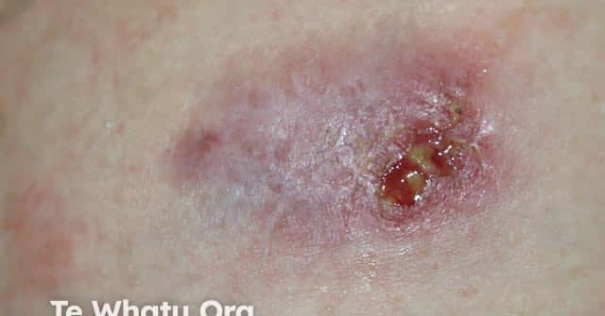 Pyoderma gangrenosum image
