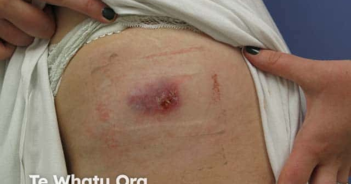 Pyoderma gangrenosum image