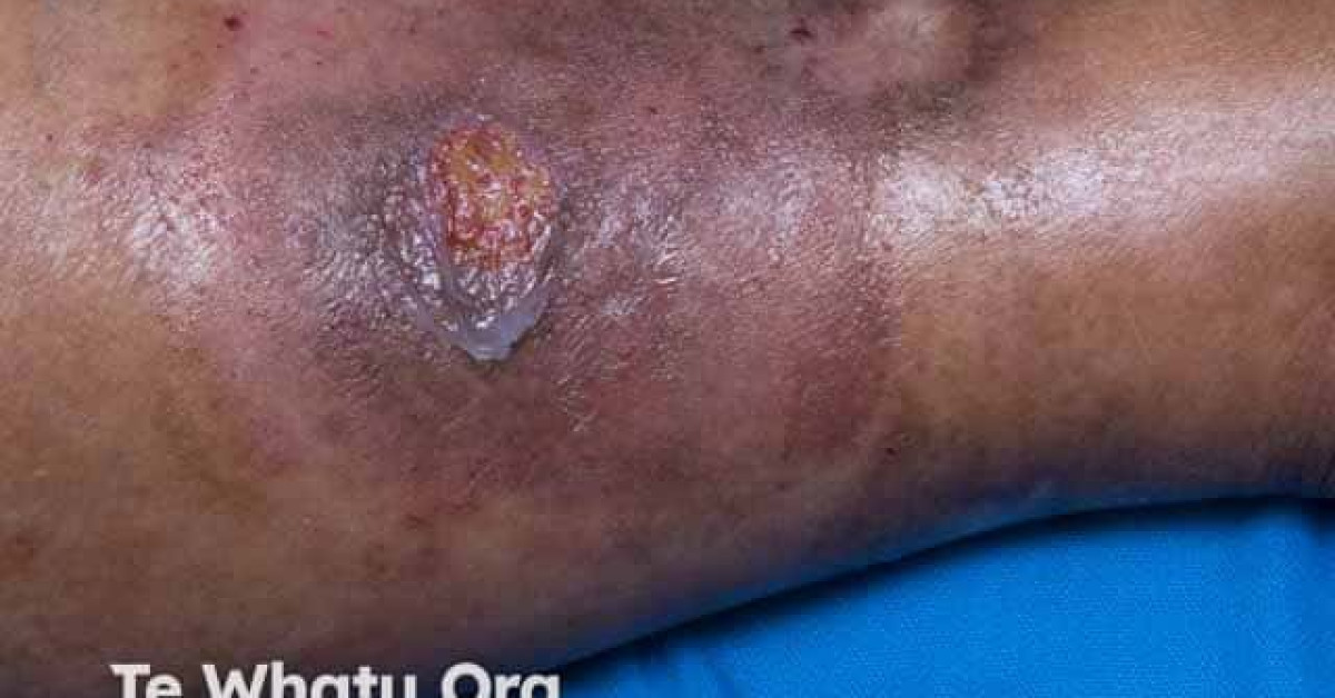 Pyoderma Gangrenosum Image