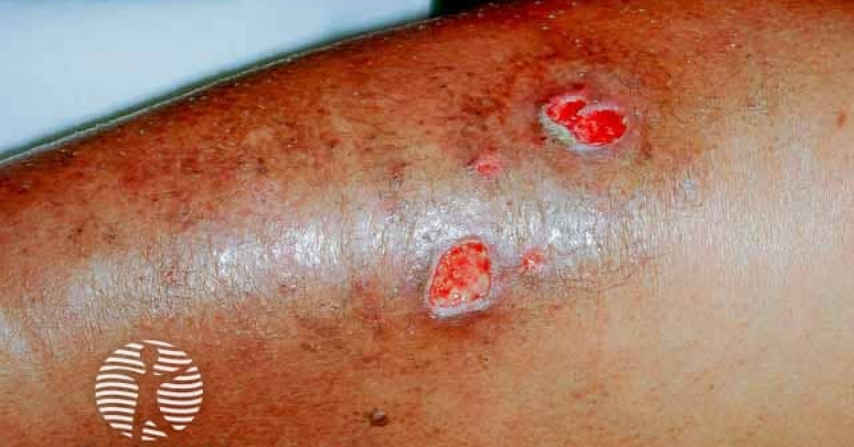 Pyoderma Gangrenosum Image