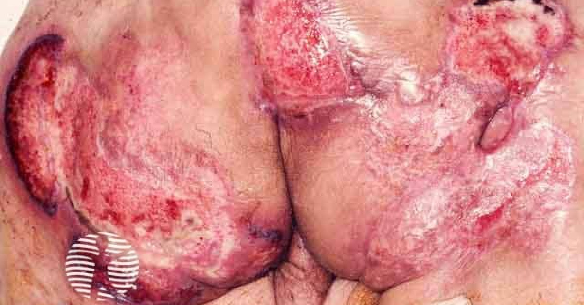 Pyoderma Gangrenosum Image