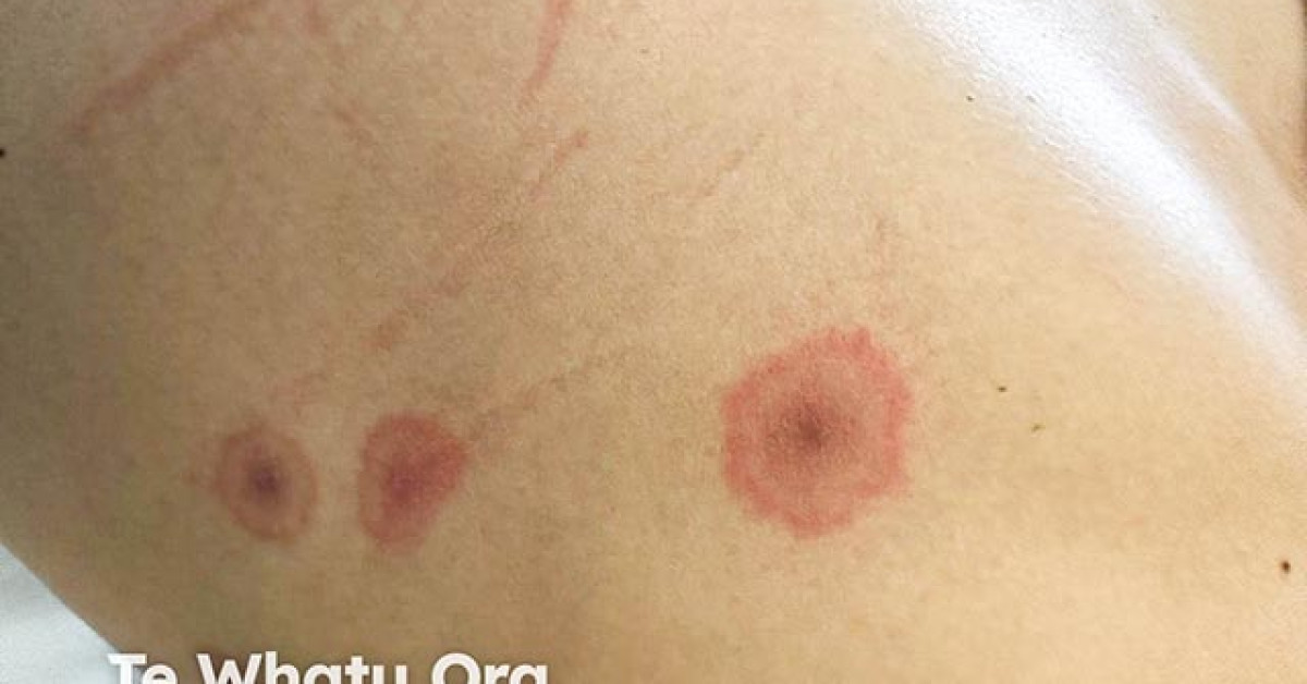 Reactive infectious mucocutaneous eruption image