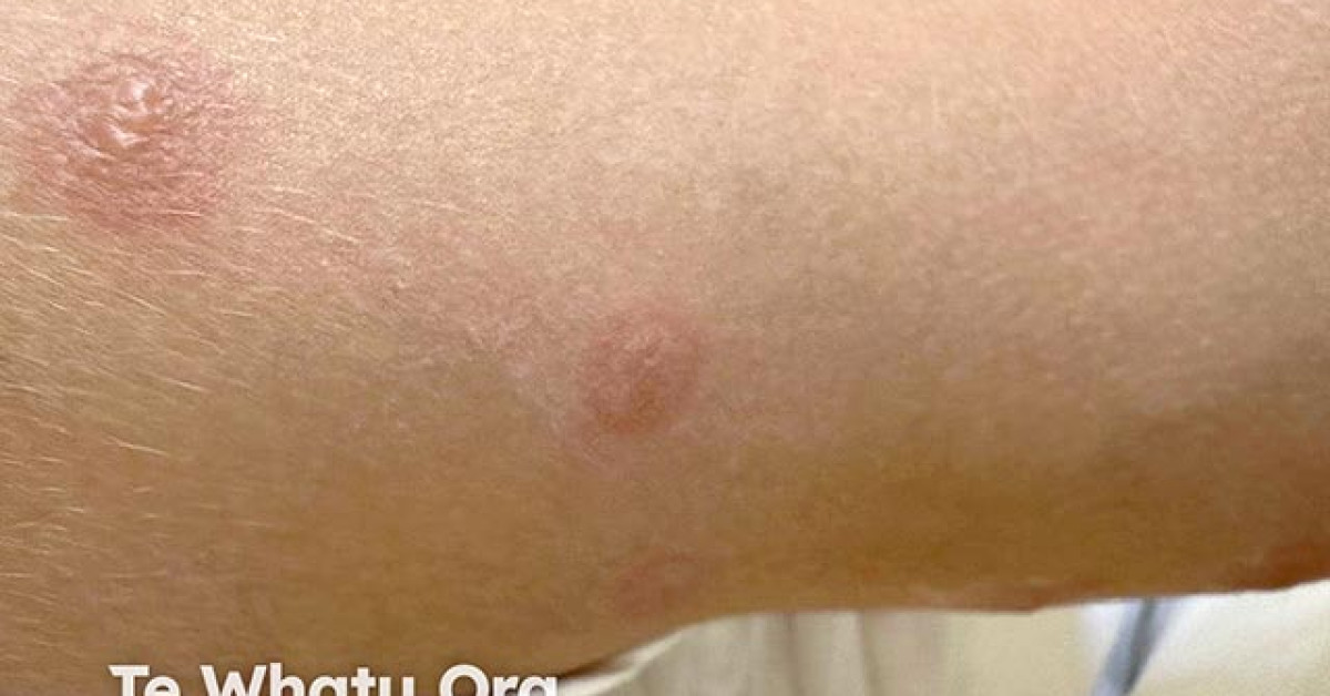 Reactive infectious mucocutaneous eruption image