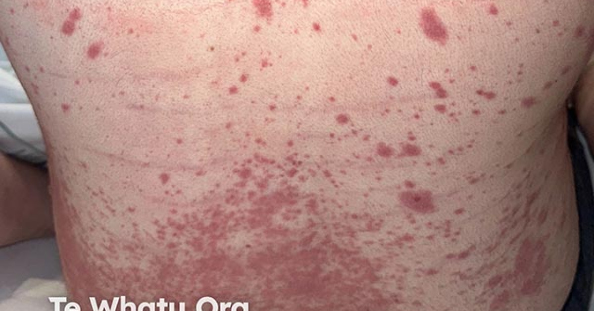 Reactive infectious mucocutaneous eruption image