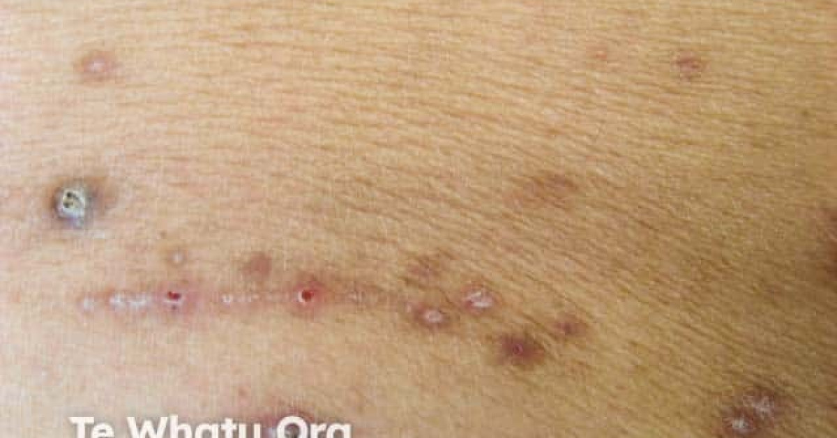 Reactive perforating collagenosis image
