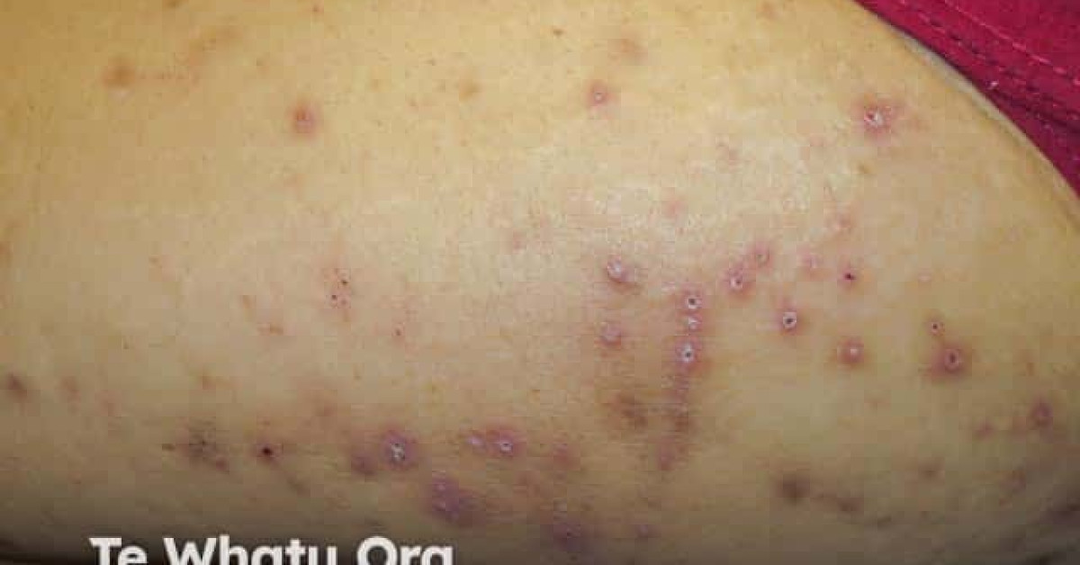 Reactive perforating collagenosis image