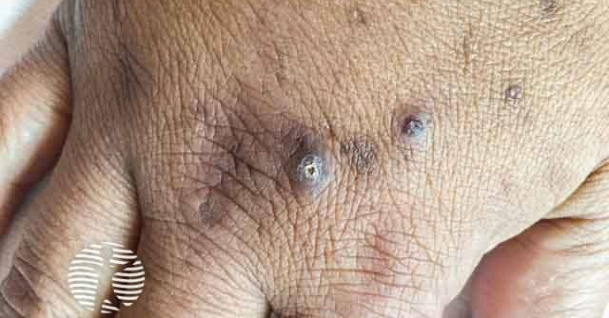 Acquired Perforating Dermatosis 後天穿透性皮膚病(acquired