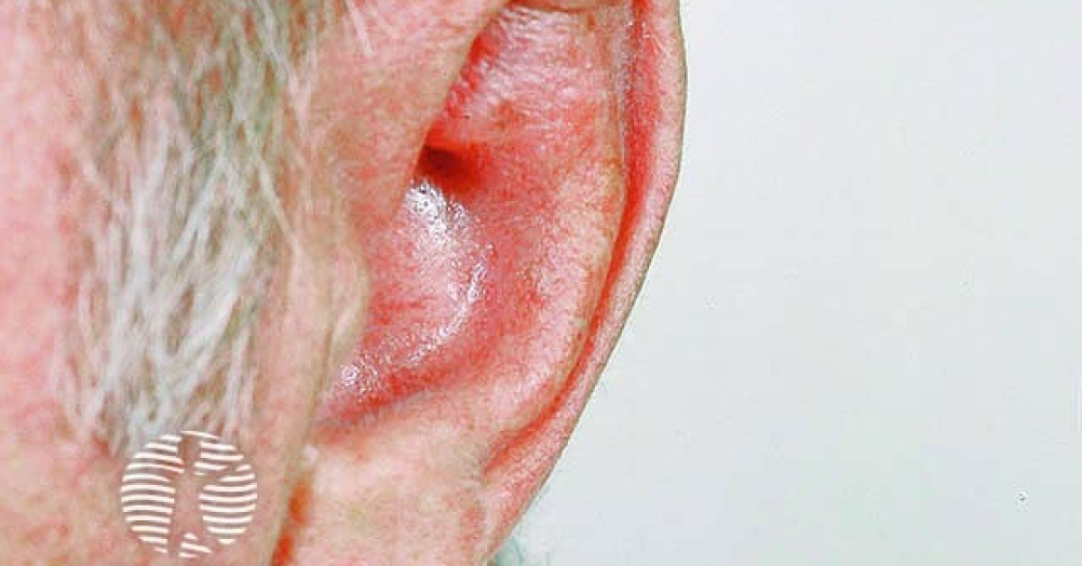 Relapsing polychondritis image