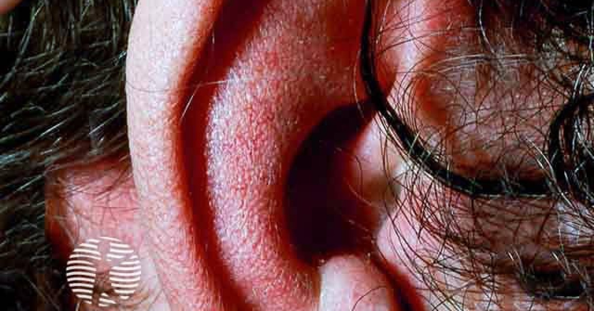 Relapsing polychondritis image