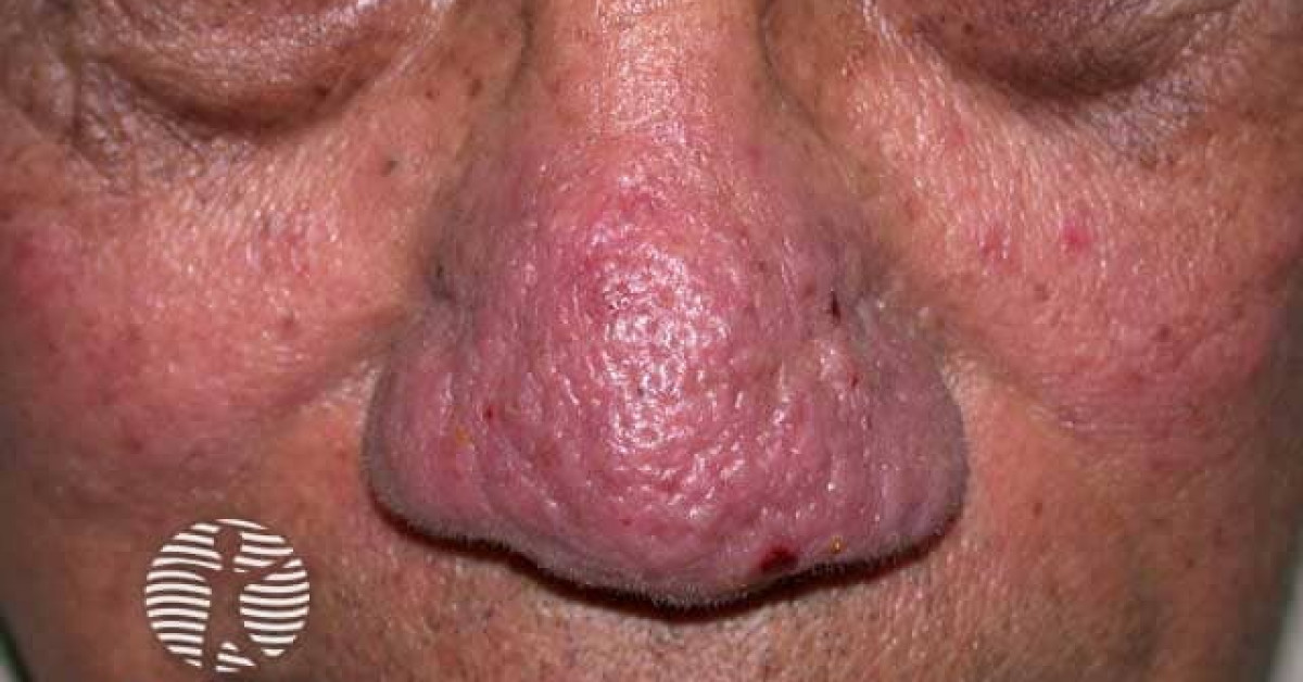 Rosacea image