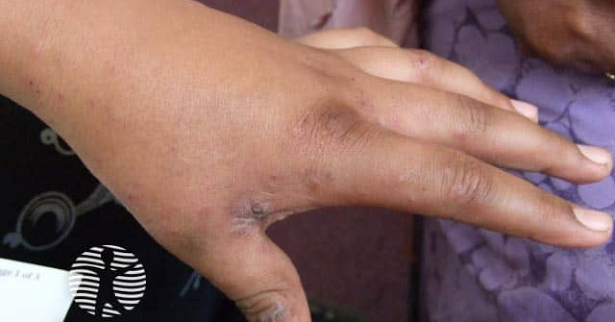 Scabies image