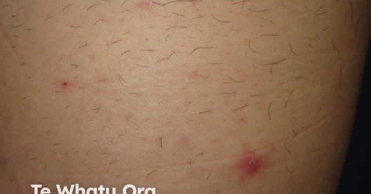 Scabies image