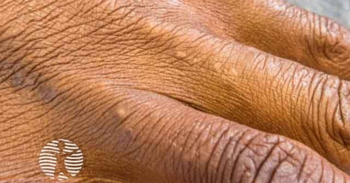 Scabies image