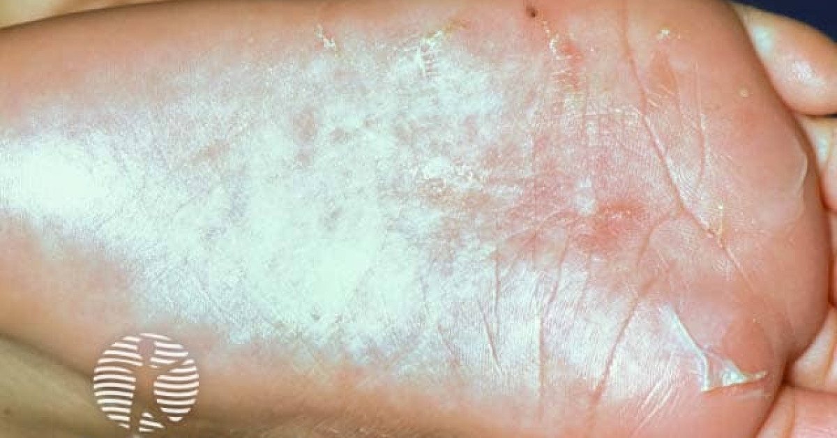 Scabies image