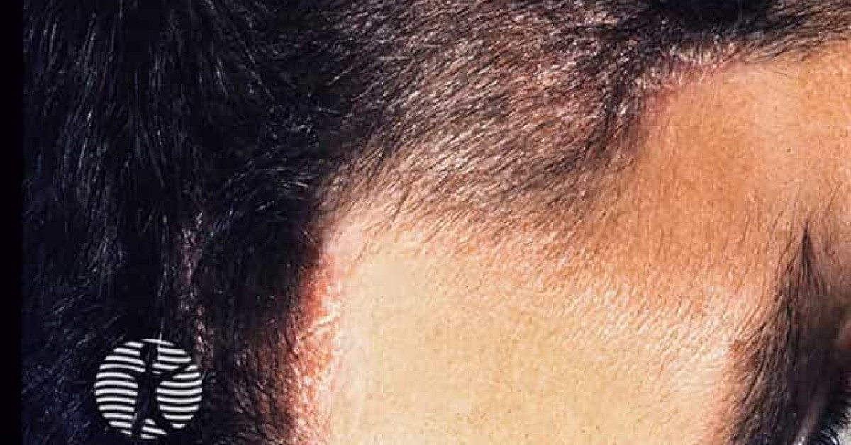 Scalp psoriasis image