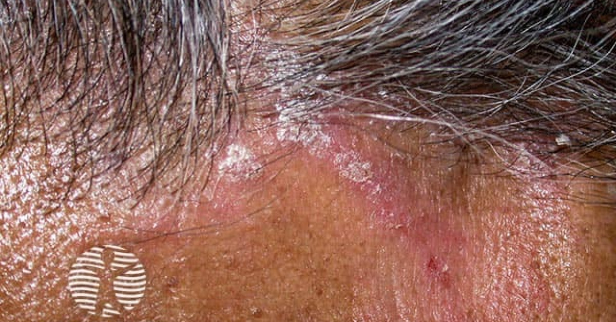 Scalp psoriasis image