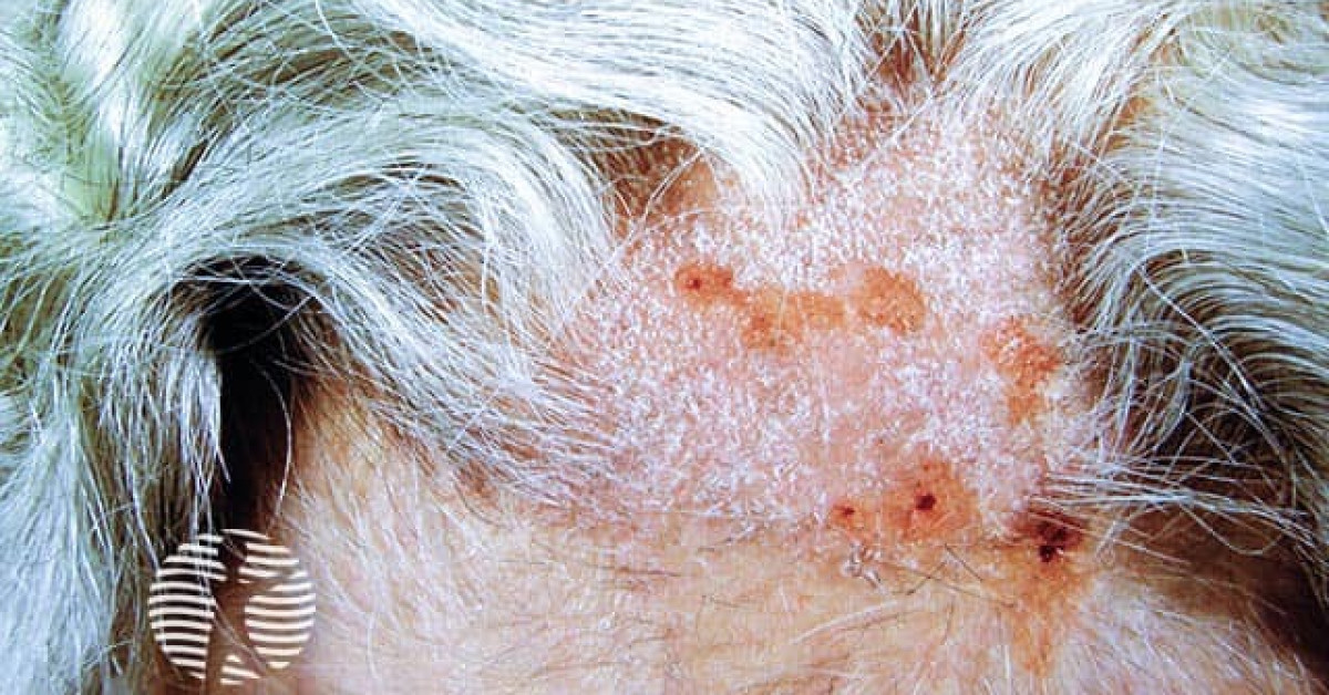 Scalp psoriasis image
