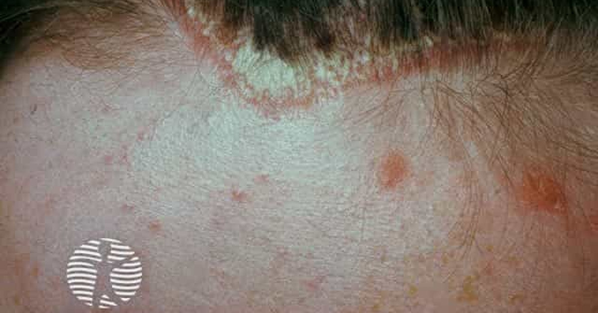 Scalp psoriasis image