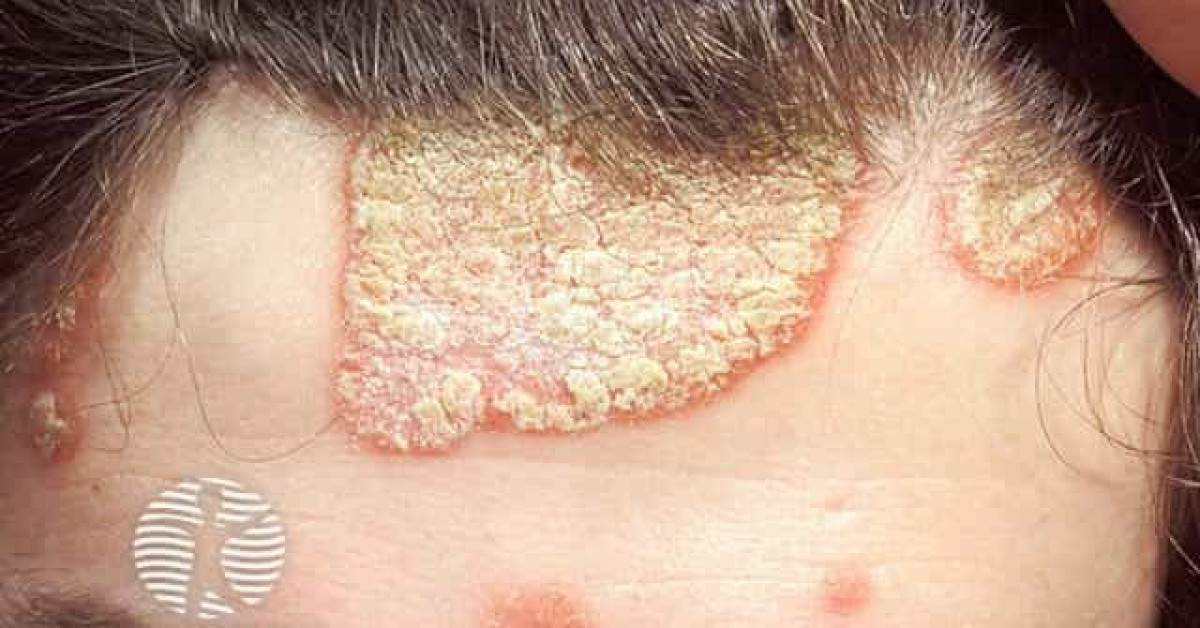 Scalp psoriasis image