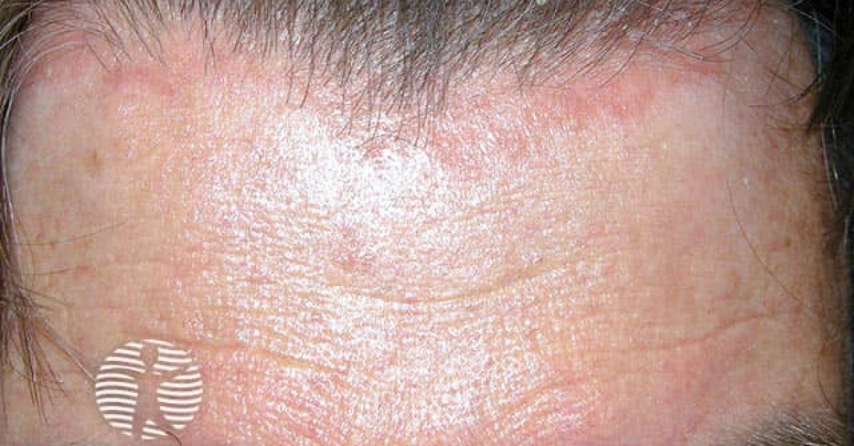 Scalp psoriasis image