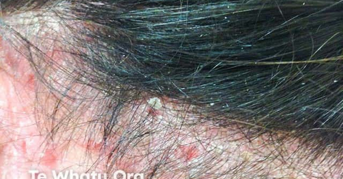 Scalp psoriasis image