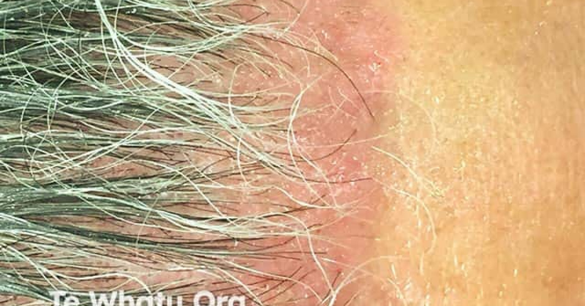 Scalp psoriasis image
