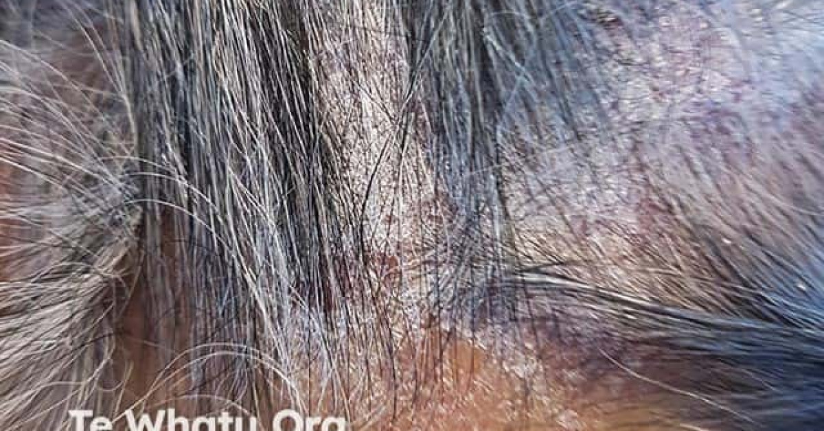 Scalp psoriasis image